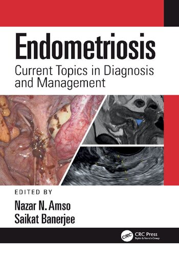 Endometriosis: Current Topics in Diagnosis and Management (PDF/EPUB ... Endometriosis: Current Topics in Diagnosis and Management (PDF/EPUB ...